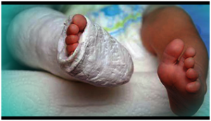 Treatment of Arthrogryposis - Dr Ratnav Ratan