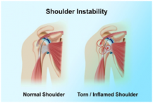 Causes of shoulder pain in teens and adolescent kids - Dr Ratnav Ratan